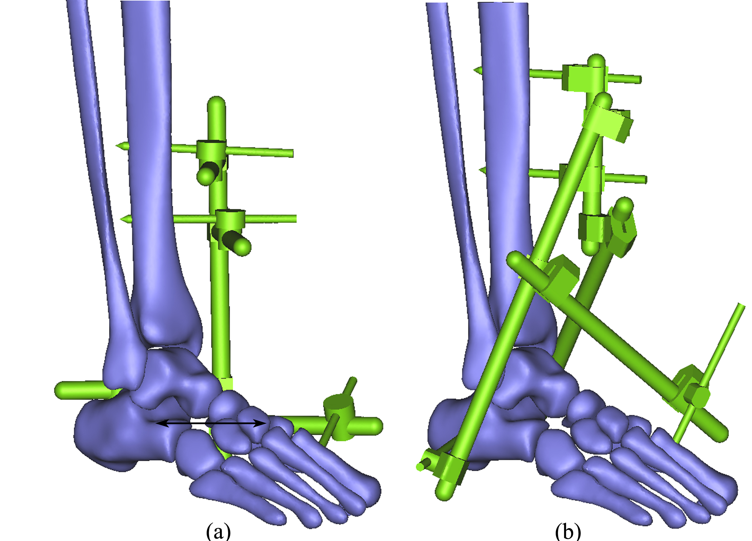 The Important of External Fixator Choices in Treating Bone Fracture ...